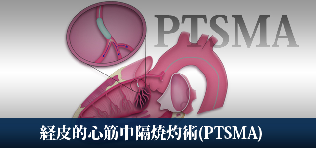 経皮的心筋中隔焼灼術(PTSMA) – 岩手医科大学附属病院ハートセンター